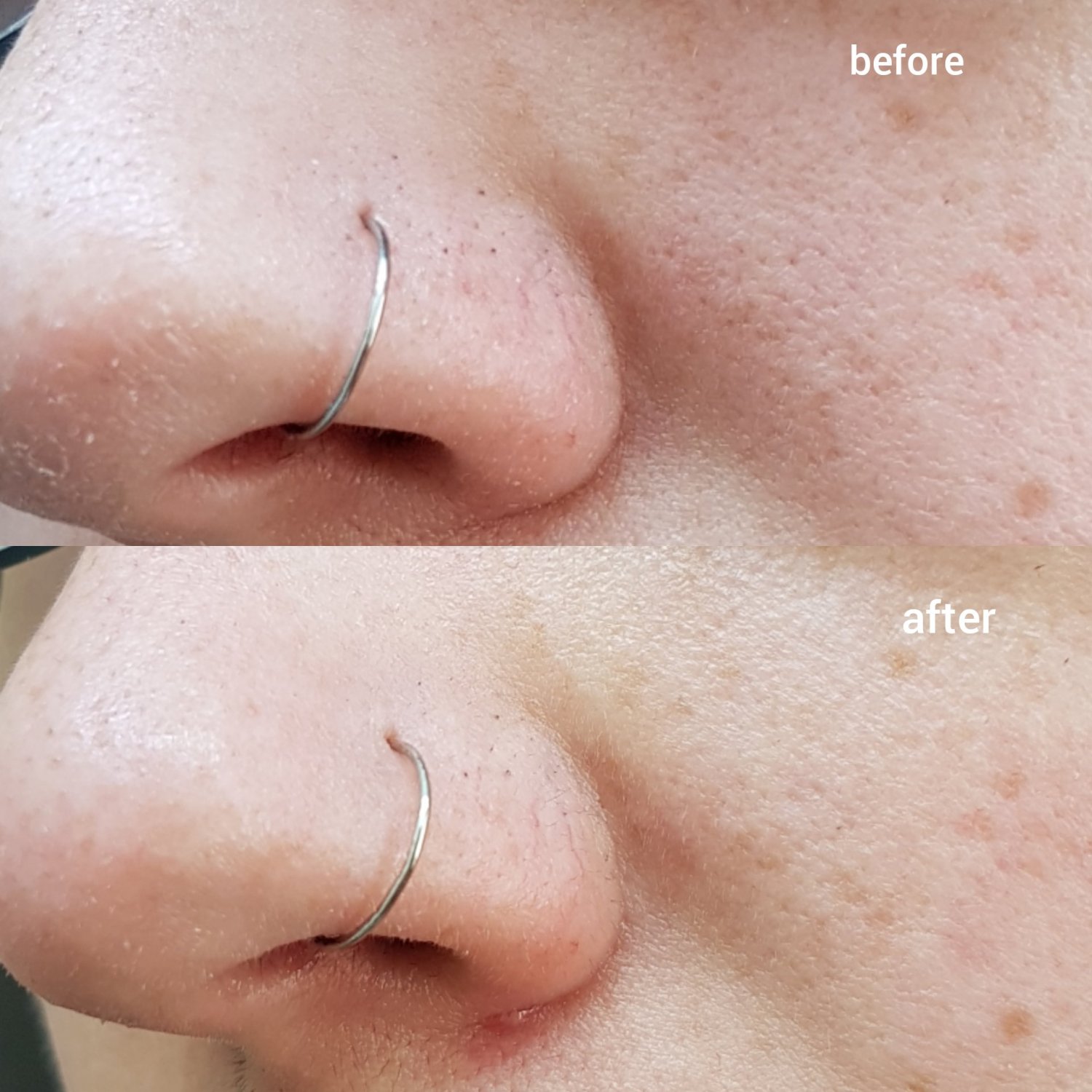 Dermalogica Blackhead Clearing Fizz Mask Review | Raiyne On Beauty