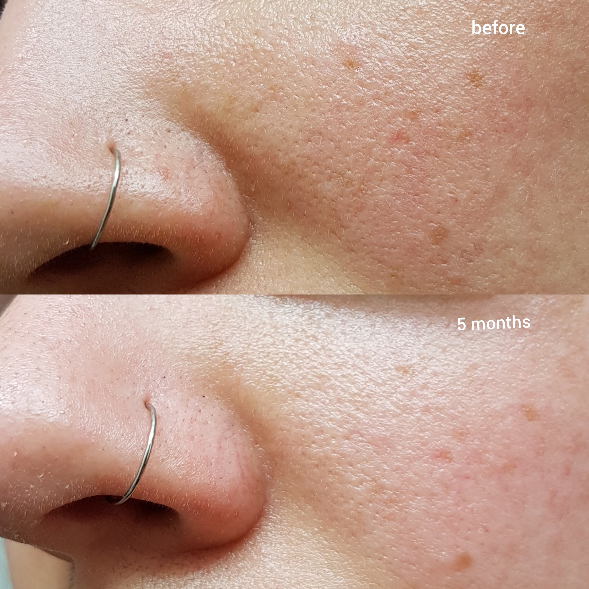 Cosrx BHA Blackhead Power Liquid Review | Raiyne On Beauty